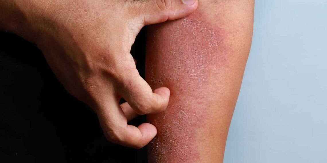 Managing Skin Irritation Caused by Mold Exposure: Tips and Remedies ...